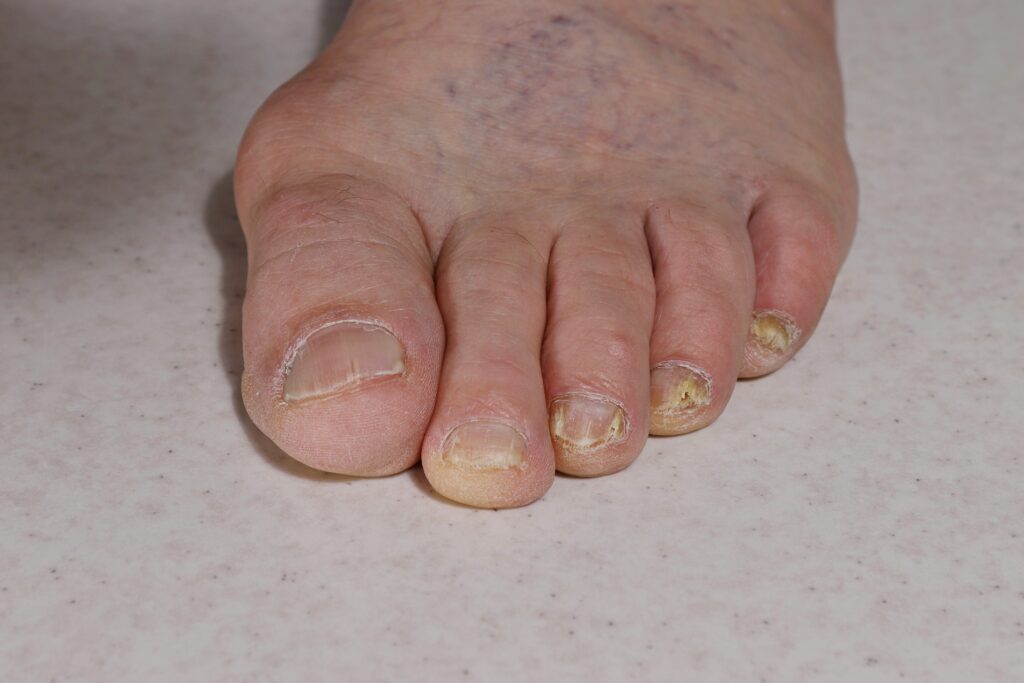Nail Fungal Infections: Causes and Early Warning Signs | Callidora ...
